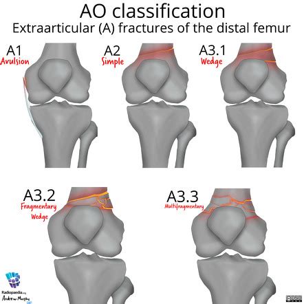 Ao Classification Of Distal Femur Fractures Radiology Reference My The Best Porn Website