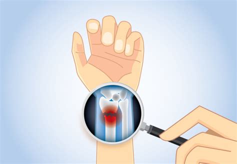 Hand Fracture Types Symptoms Causes Treatment Zealmax
