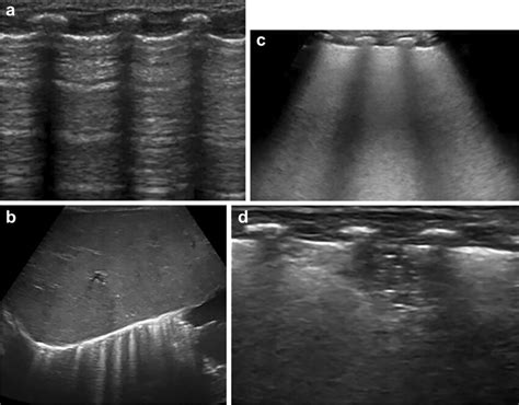 Normal Lung Ultrasound Pattern In A Newborn Girl Transthoracic
