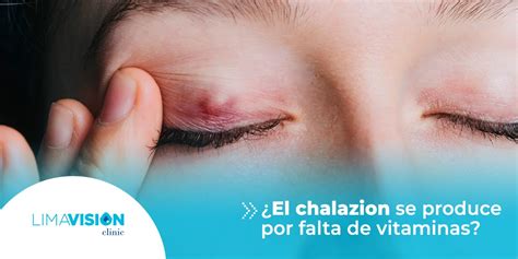 Chalazion qué es como se trata y diferencias con el orzuelo