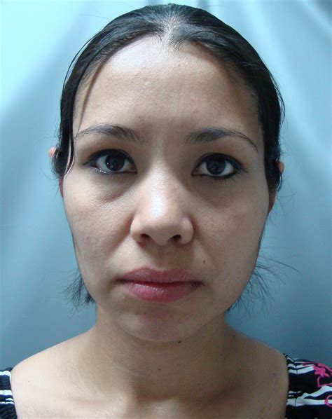 Cirug A Pl Stica Guatemala Dr Salvador Recinos Otoplastia Cirug A