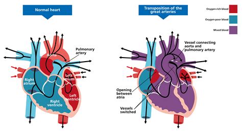 Transposition Of The Great Arteries Knowledge Hub