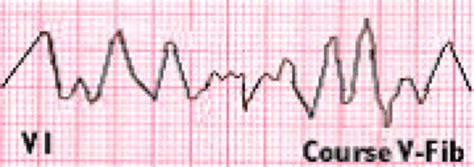 Ventricular Fibrillation Vf Pulseless Ventricular Tachyc American