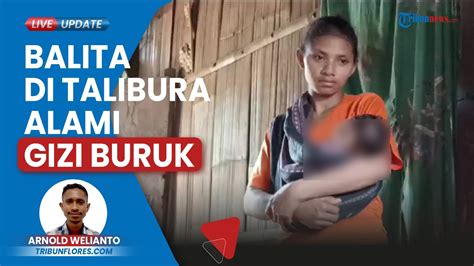 Tak Miliki Biaya Ke RS Kondnisi Balita Gizi Buruk Di Talibura Sikka
