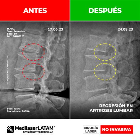 Martina Melendez Regresi N En Artrosis Lumbar Medilaser Per