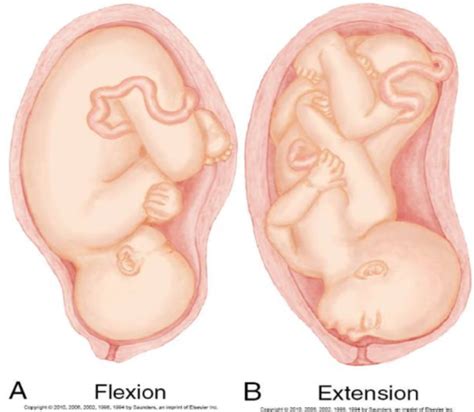 Giving Birth Intrapartum Care Flashcards Quizlet