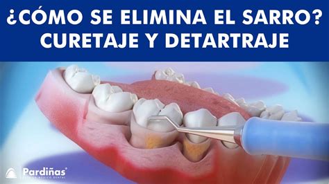 Cómo se ELIMINA EL SARRO Curetaje y limpieza dental YouTube