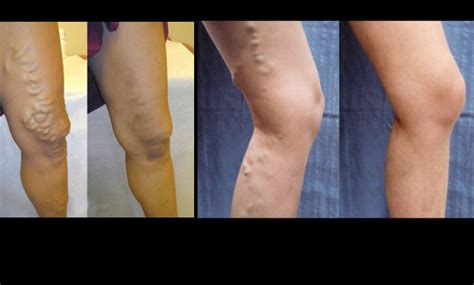 Varicose Veins Symptoms Treatment Ucsf Radiology
