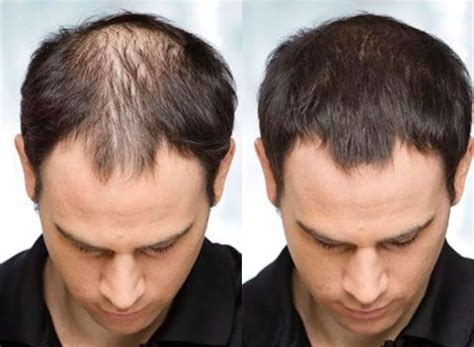 Ricrescita Dei Capelli E Anticaduta Il Metodo Rivoluzionario Scoperto