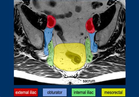 Floor Of Mouth Cancer Staging Radiology Assistant Viewfloor Co