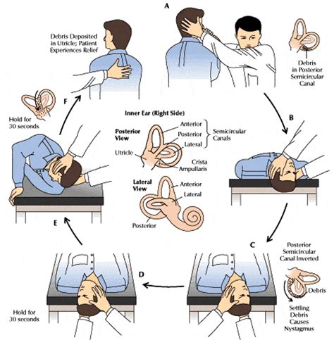 Vertigo Bppv Port Melbourne Physiotherapy Pilates