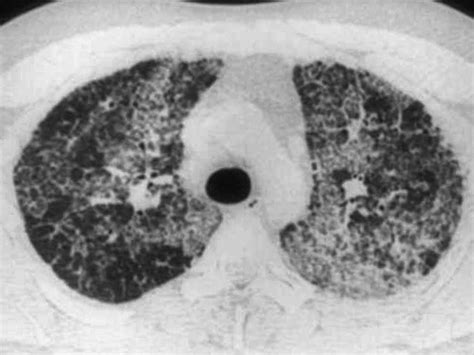 Pulmonary Alveolar Proteinosis