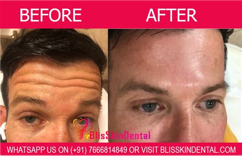 Botox Before And After Men