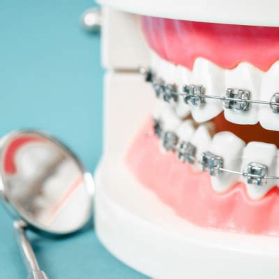 Braces Color Wheel Artofit