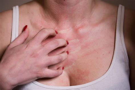 Manchas rojas en la piel A qué se deben y cómo prevenirlas