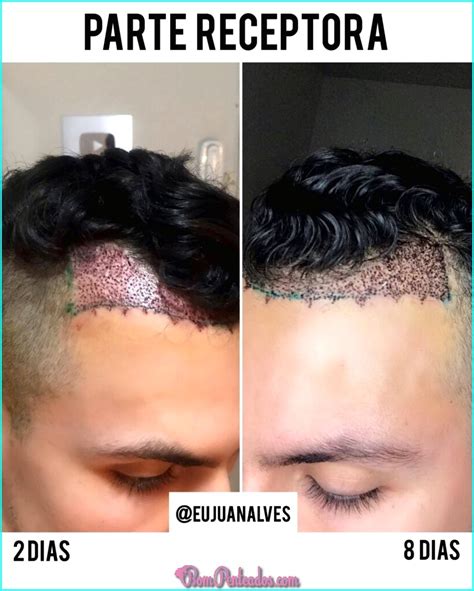Transplante De Fue Capilar Capilar Cuidados Bom Penteados