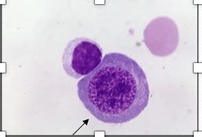 Hematology Lecture Megaloblastic Anemia Flashcards Quizlet