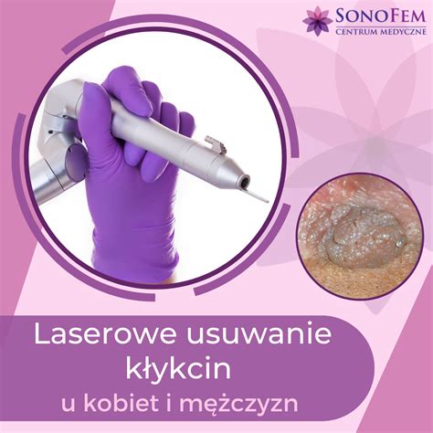 Laserowe usuwanie kłykcin ze sromu i okolic intymnych pod kontrolą