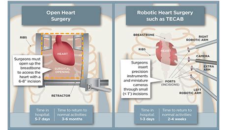Totally Endoscopic Coronary Artery Bypass TECAB Surgery UChicago