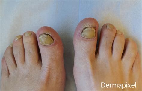 Como Quitar Uñas Amarillas De Los Pies favorcought