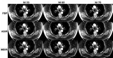 image quality assessment of standard and low dose chest ct using filtered back projection