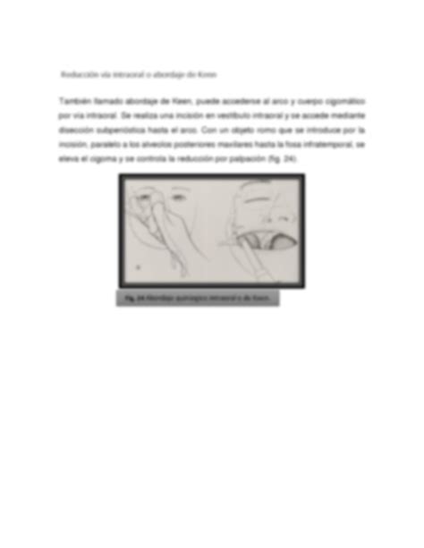 Solution Abordaje Quir Rgico De Gilles Y Keen Para Fracturas De