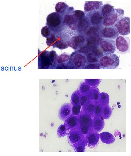 Lecture Neoplasia Flashcards Quizlet