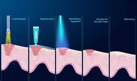 Photodynamische Therapie Nürnberg Noris Dermatologie