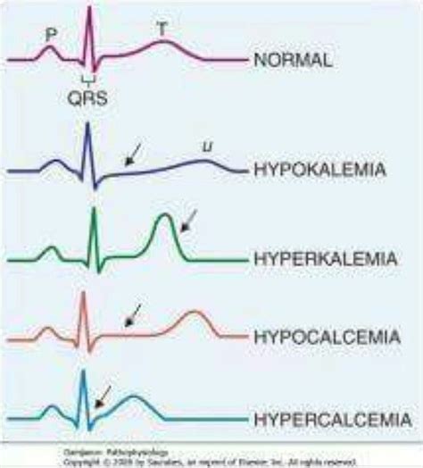 Ekg And Electrolyte Imbalance