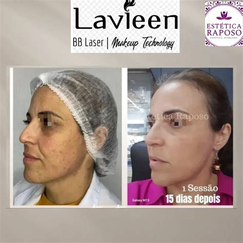 Laser Lavieen Preço Estética Raposo