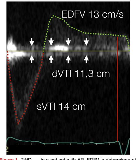 Figure 1 From PulsedWave Doppler Recordings In The Proximal Descending