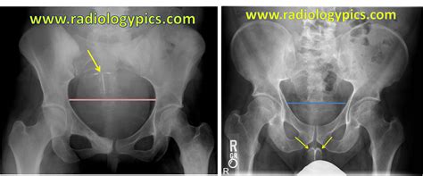 Intrauterine Device Radiologypics