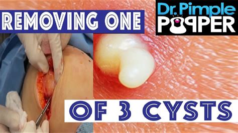Top Terrible Pus Cyst Removal And Popping Pimple Dr Pimple Popping Youtube
