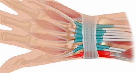 Wrist Tendonitis Symptoms Causes Treatment Rehabilitation
