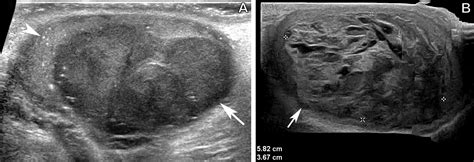 Testicular Germ Cell Tumors Classification Pathologic Features Imaging Findings And