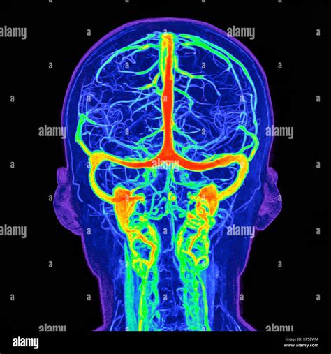 Intracranial Blood Vessels Hi Res Stock Photography And Images Alamy