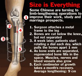 Leg Shortening Surgery Recovery Timeline