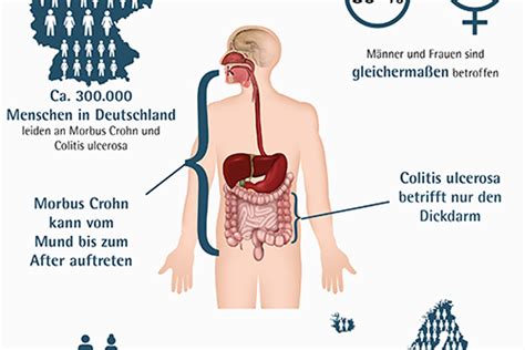 5 Fakten Zu Morbus Crohn Und Colitis Ulcerosa Diakoneo
