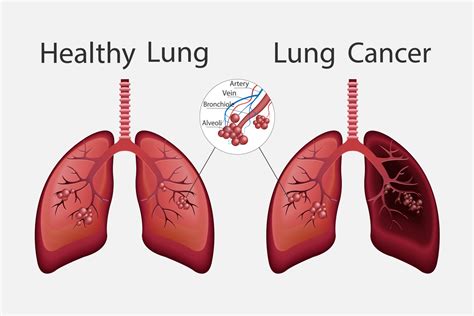 Healthy Lungs Vs Unhealthy Lungs