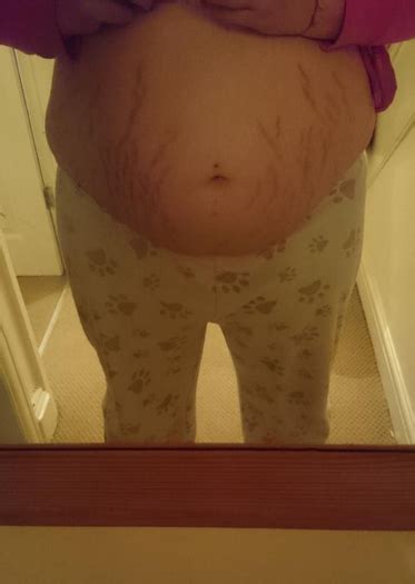 Photos Pregnancy Stretch Marks Babycentre Uk