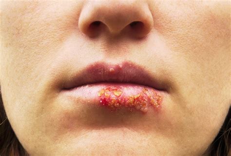 Lippenherpes Symptome Bilder Und Hausmittel