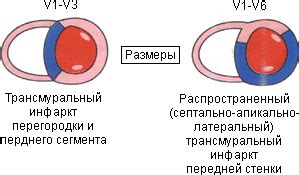 Экг при инфаркте миокарда фото с расшифровкой