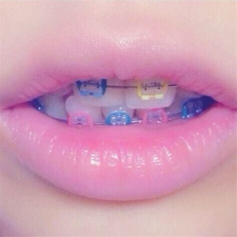 Cute Braces Colors Brace Face Catty Noir Mabel Pines Girly Lip Art