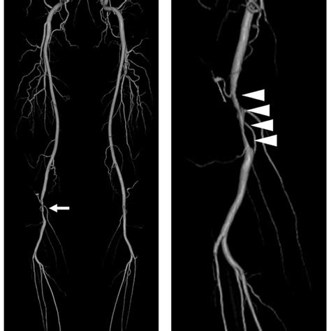 Three Dimensional Computed Tomography Angiography Of The Lower Limb