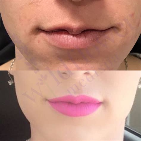 This Patient Had One Plasma Pen Lip Flip And Juvederm Ultra Xc Filler