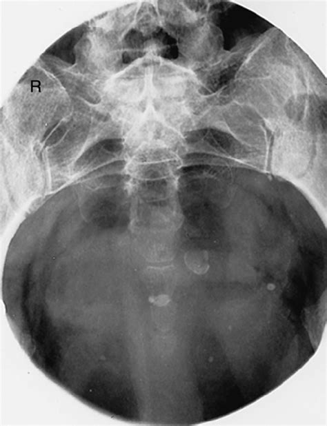 AP Axial Coccyx Diagram Quizlet
