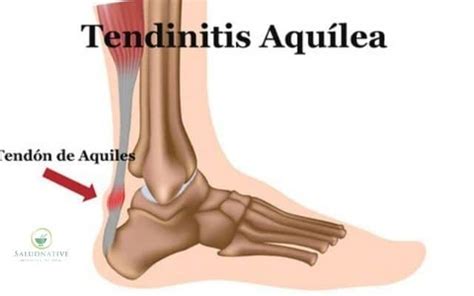 Tendinitis En El Talón De Aquiles Tratamientos Caseros Saludnative
