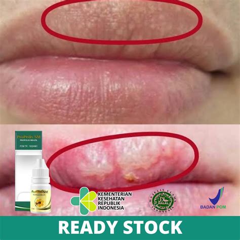 Jual Obat Untuk Bintik Putih Di Bibir Bibir Bintik Bintik Gatal