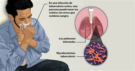 Comprensión de su prueba de tuberculosis TB Recharge Medical
