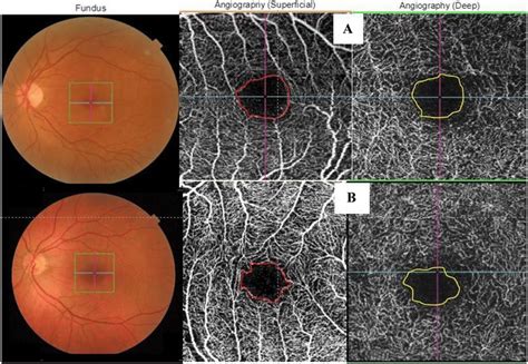 3 3 Mm OCT A Images Of A Foveal Avascular Zone Area In Superficial